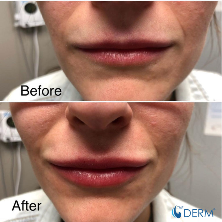 Restylane® Silk - The Derm | Dermatologists in Cook County, IL