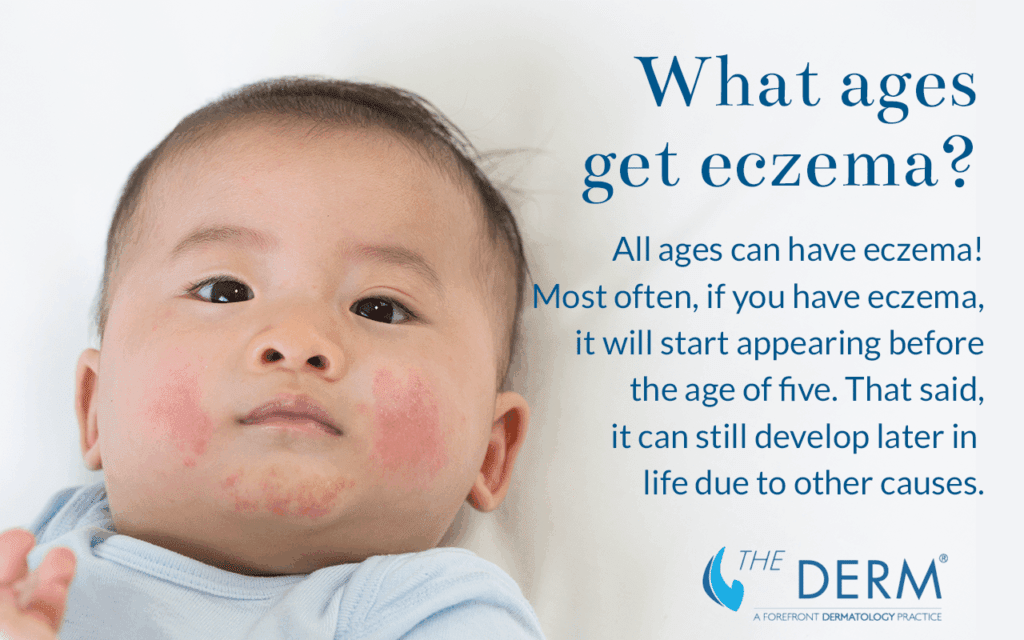 Eczema: What to Know & Treating It Well in Children and Adults - The ...